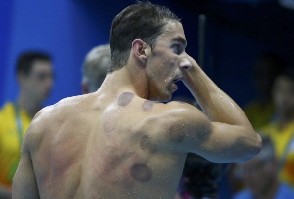Cupping Therapy – DB Fitness & Injury Clinic